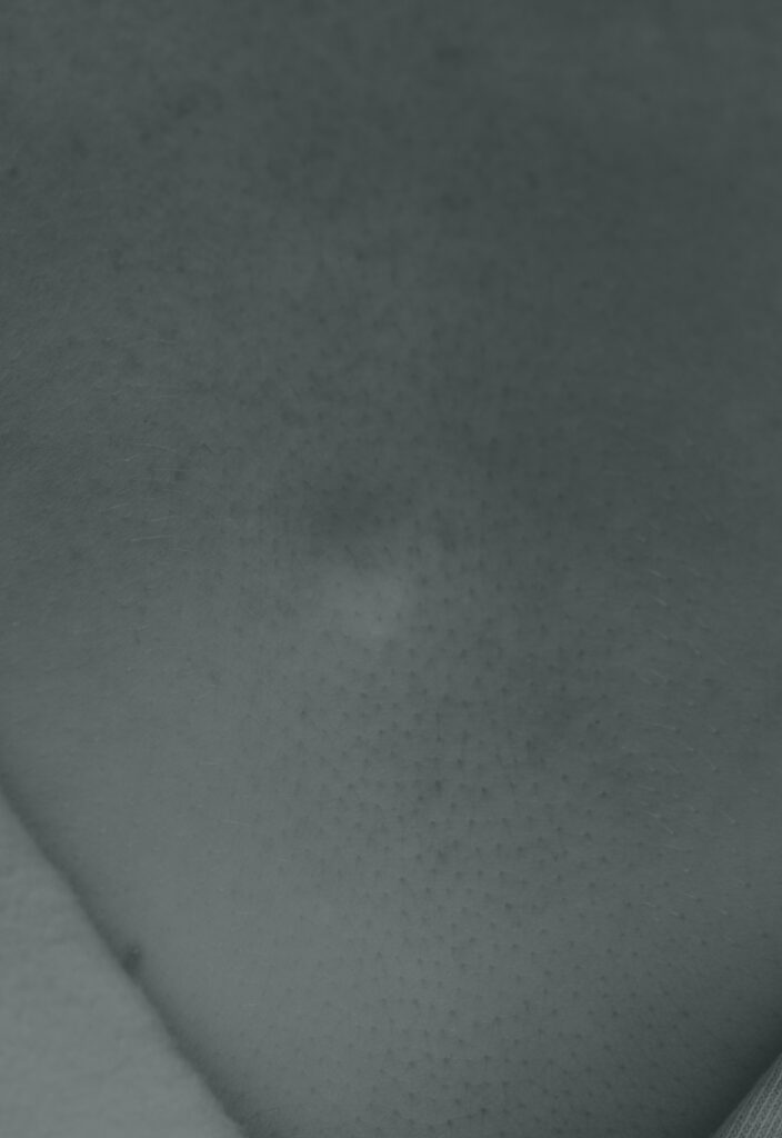 Kystes : causes et conséquences | Maxillyon | Lyon